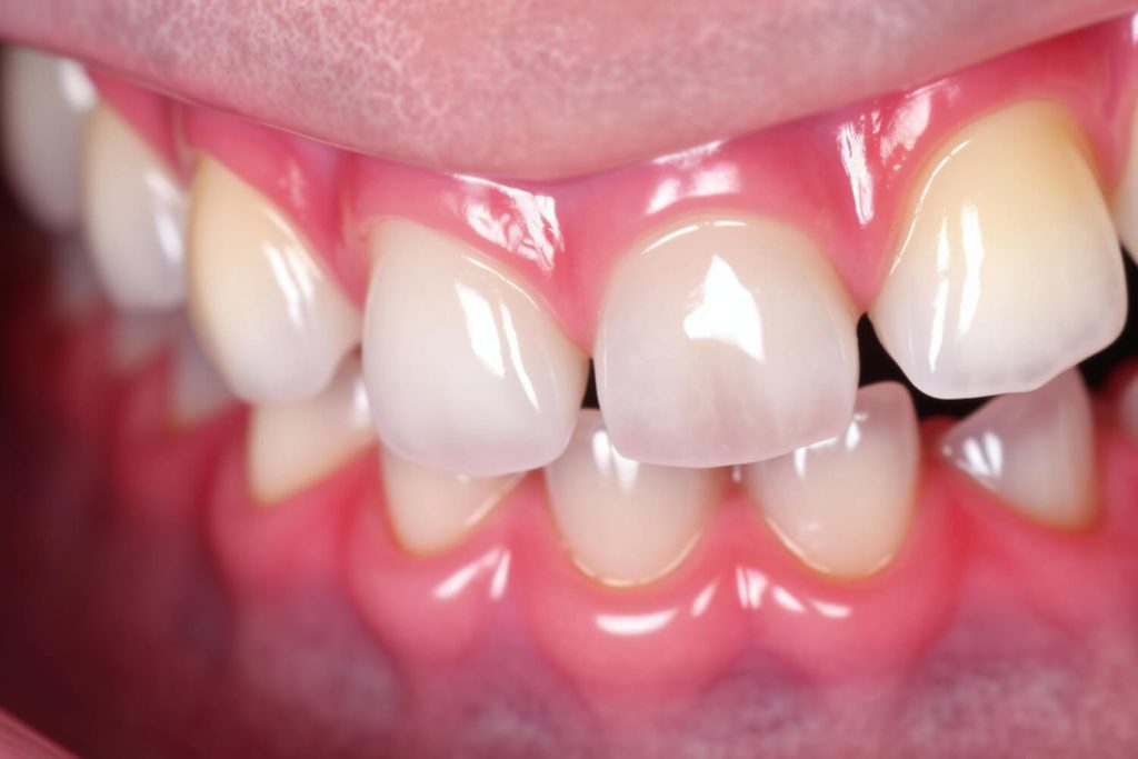 Cosmetic Dentistry - Burton Advance Dental
